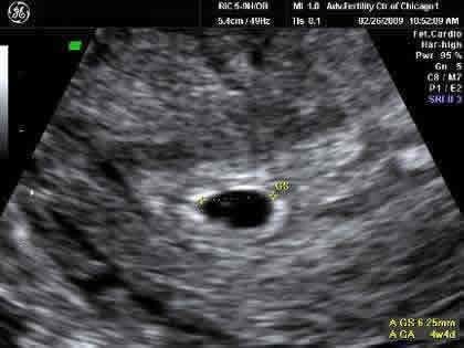 Yolk Sac 6 Weeks Ultrasound EmDOCs.net – Emergency Medicine