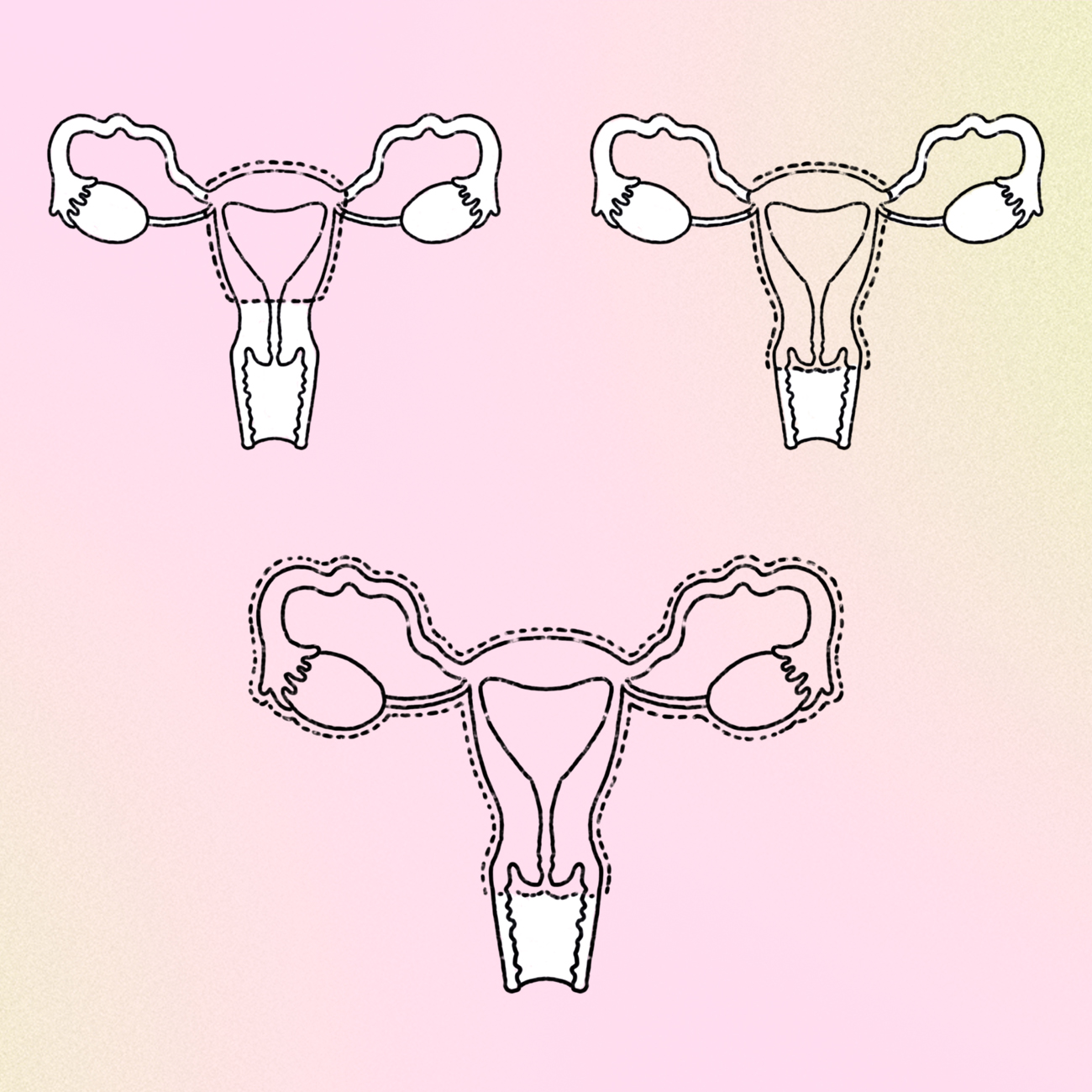 FOLX Health - Transgender Hysterectomy Guide